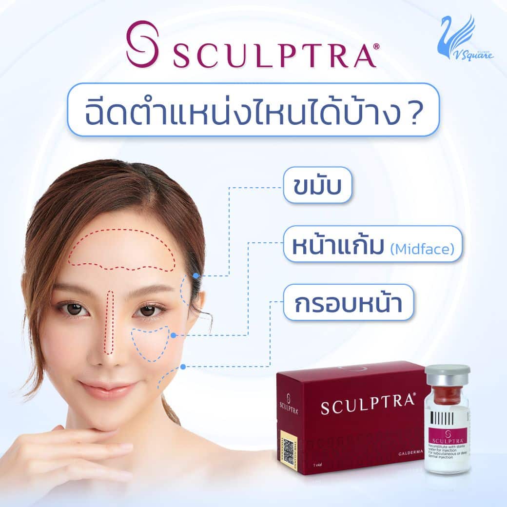 Sculptra คืออะไร ราคาเท่าไหร่ ฉีดตรงไหนได้บ้าง หลังฉีดกี่ครั้งเห็นผล