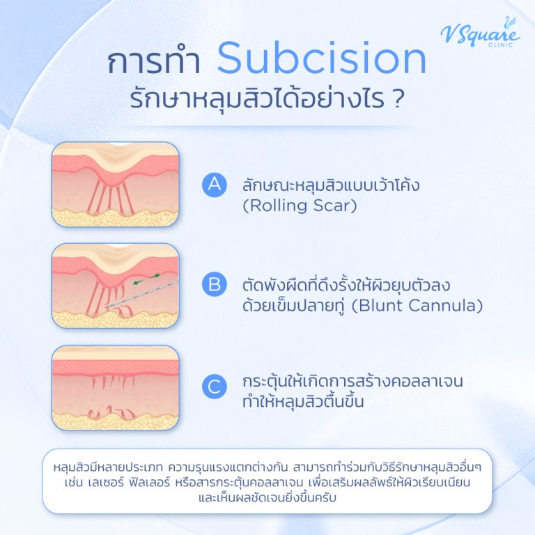Subcision คืออะไร คู่มือรักษาหลุมสิวแบบตัดพังผืด ครบจบที่นี่
